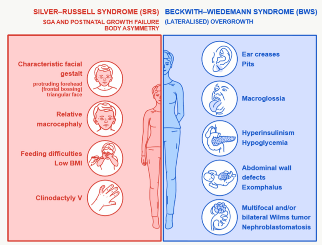 Imprinting, Imprintingerkrankungen, Silver-Russel-Syndrom, Beckwith-Wiedemann-Syndrom