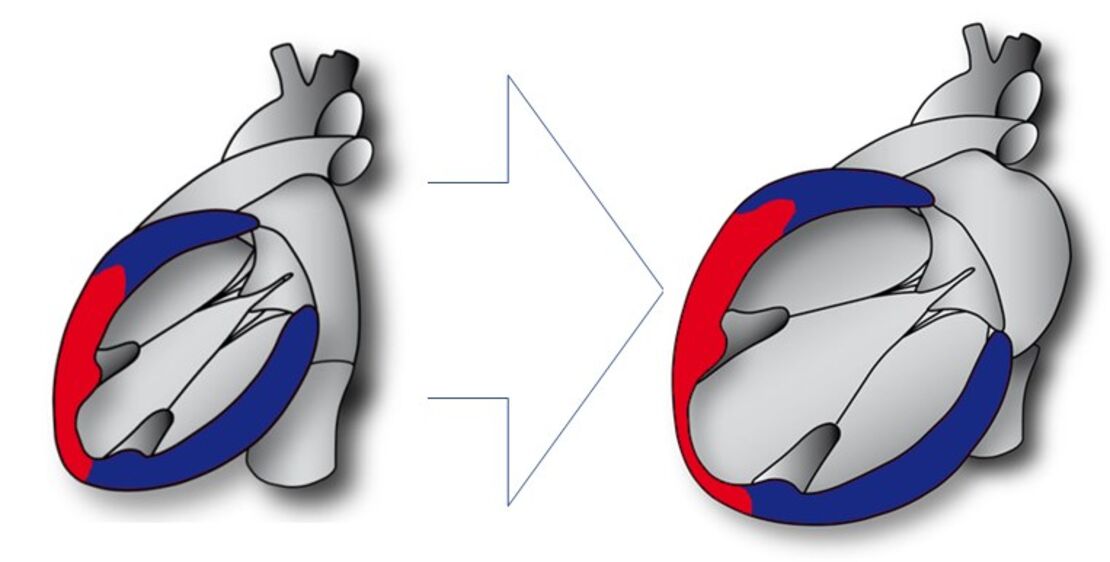 Kardiales Remodeling